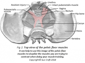 Levator Avulsion - Active Women's Health Physiotherapy